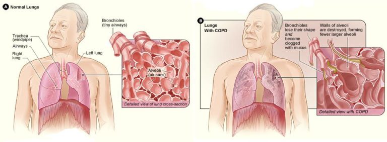 Natural Treatments for COPD: Magnesium, Ginseng, and Curcumin
