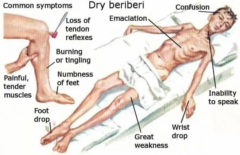 Beriberi: Overview, Types, Symptoms and Prevention
